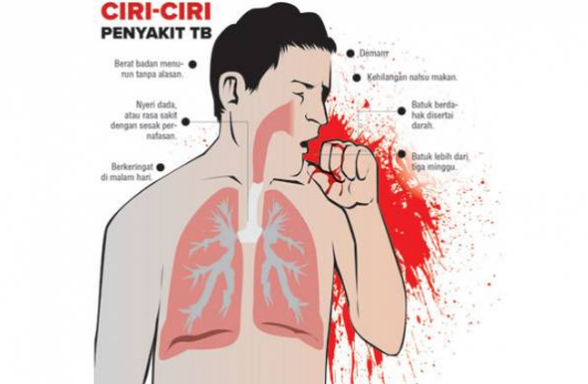 Tuberculosis Tbc Penyebab Gejala Dan Pencegahan Lengkap - Riset Tuberculosis Tbc Penyebab Gejala Dan Pencegahan Lengkap - Riset